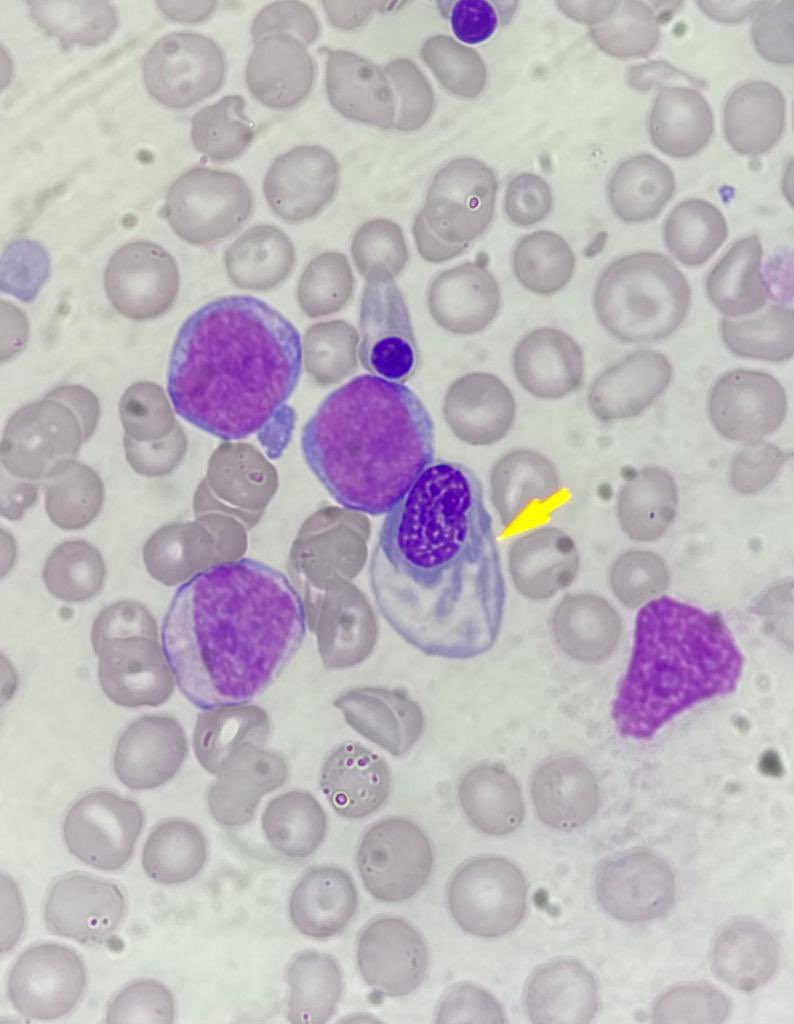 Primary Myelofibrosis Peripheral Smear