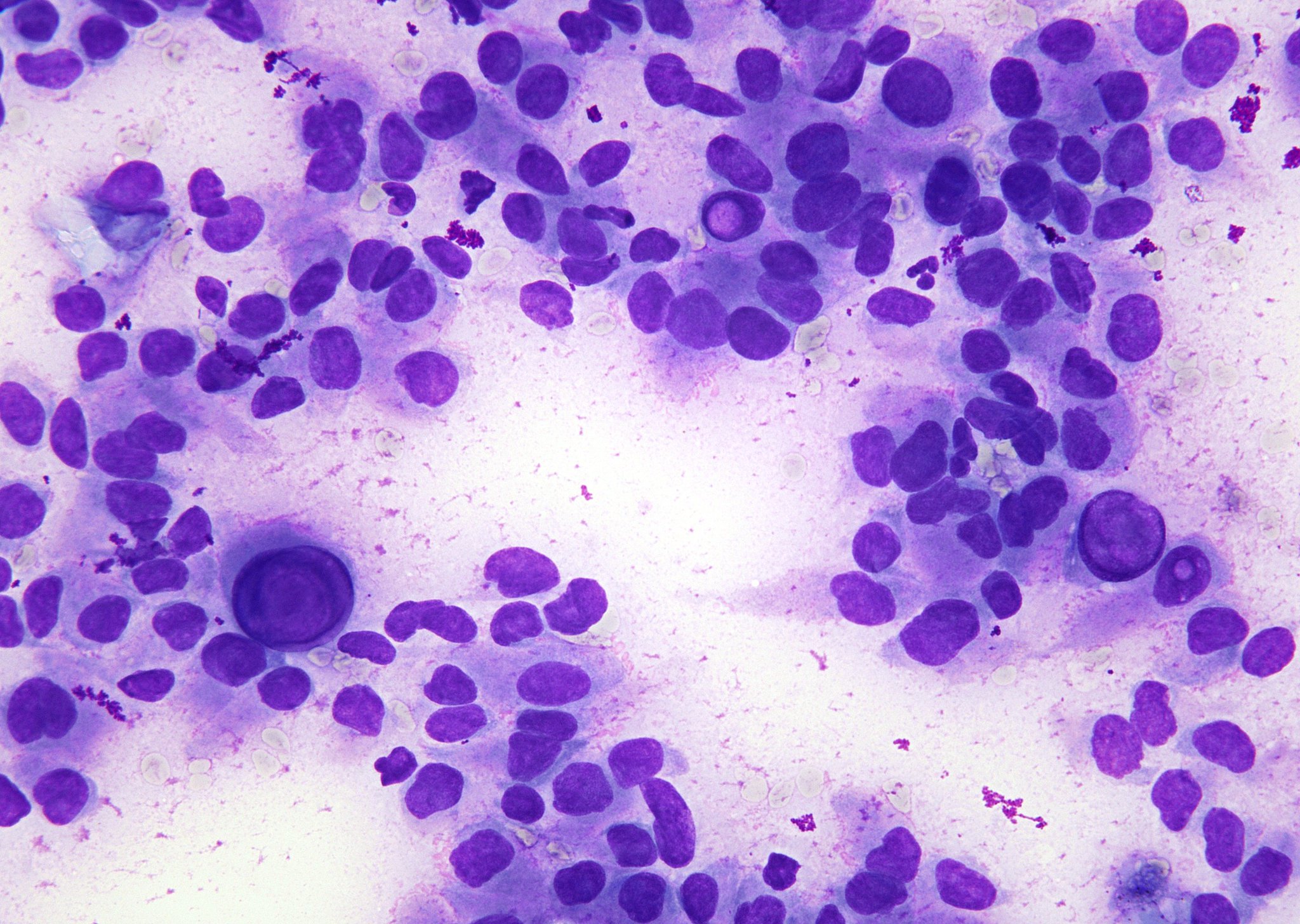 Medullary Carcinoma Cytology