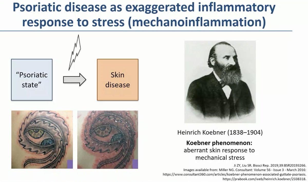 #EULAR2022 Pathogenesis of PsA PsO has similarities to Leprosy ...