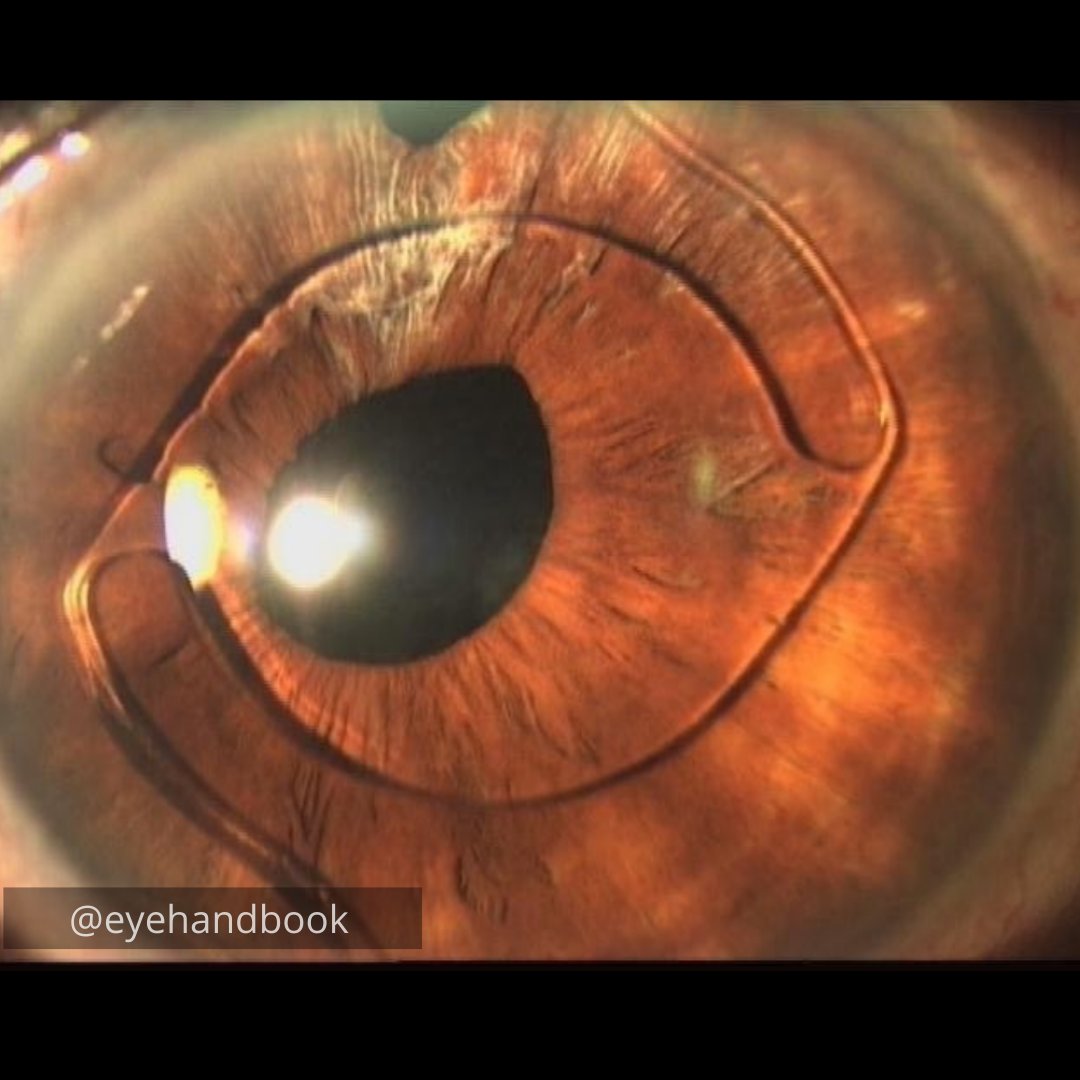 Aciol Anterior Chamber Iol Piece