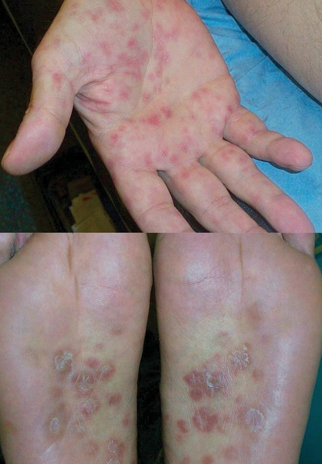 Maculopapular Rash Syphilis