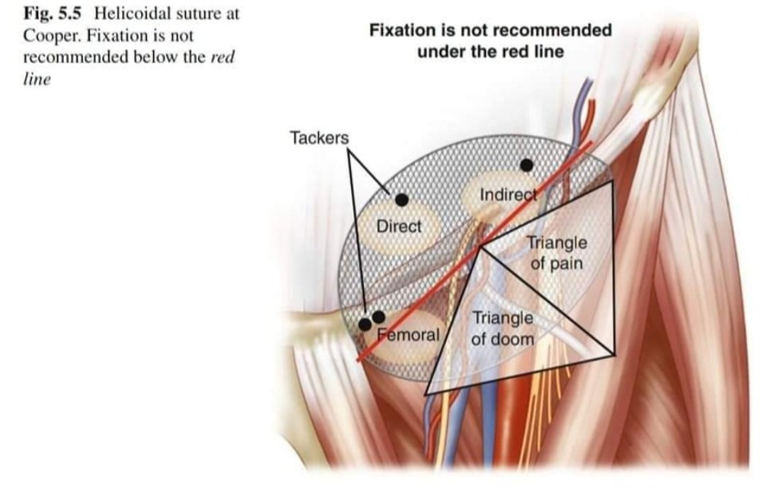 Laparoscopic Inguinal Hernia Repair Triangle Of Doom
