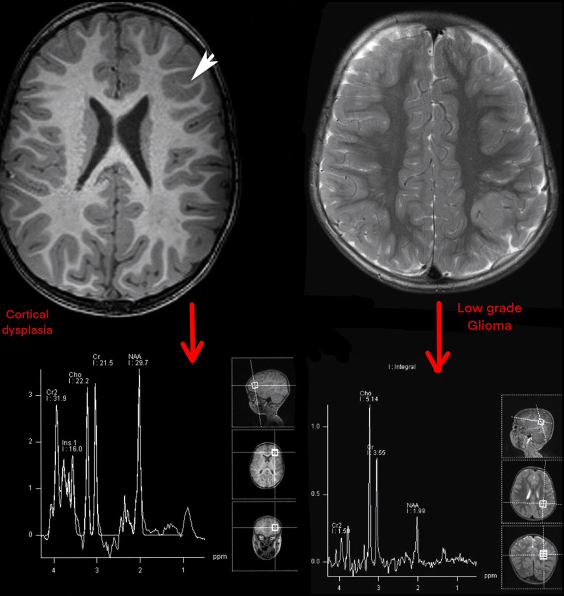 MRS for non-radiologist Part 2: Goal: Learn how different disease ...