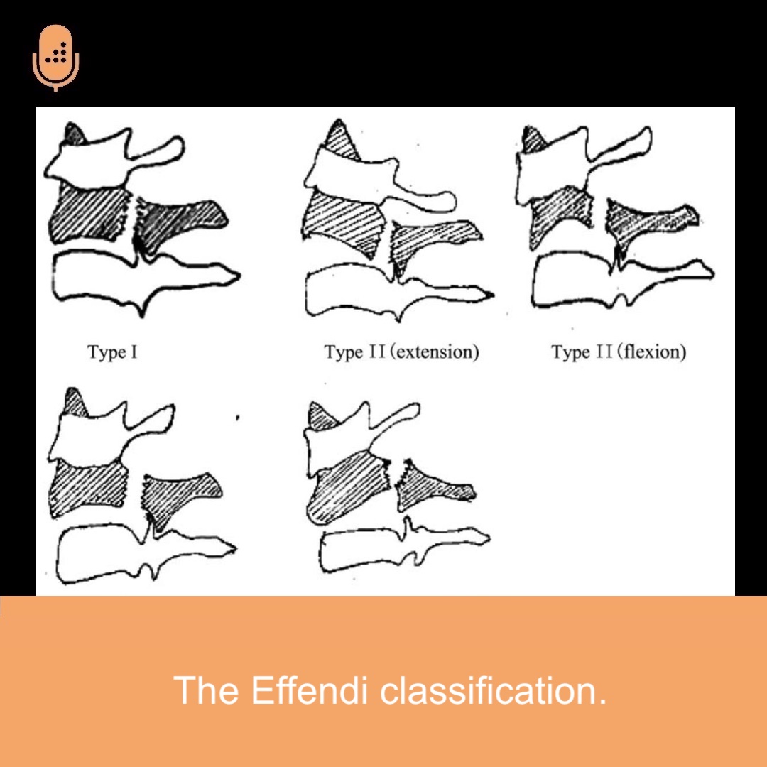 Hangmans Fracture Effendi