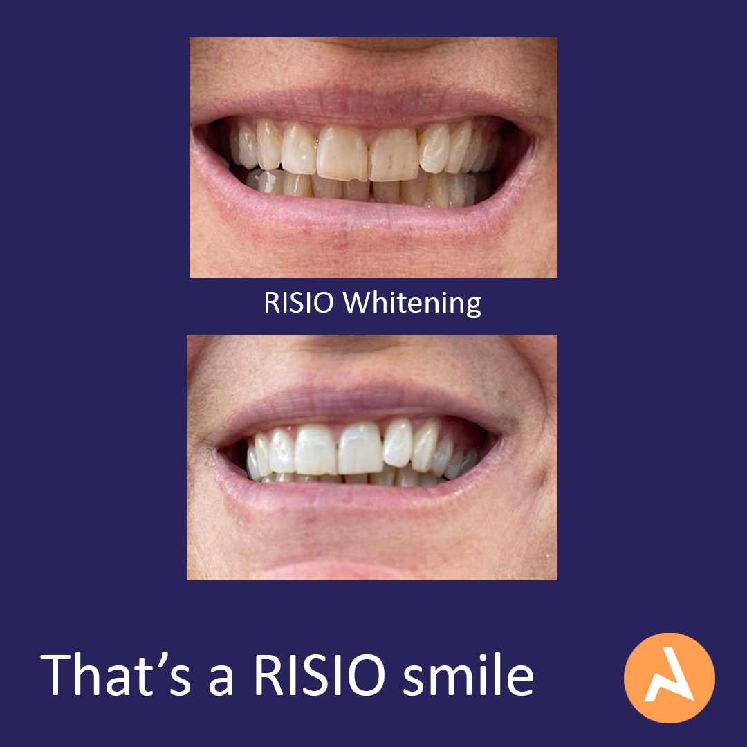 Teeth Whitening Before And After Crest