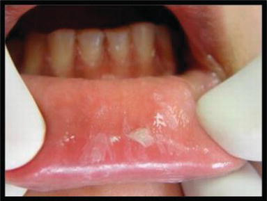 Morsicatio Buccarum Temporalis