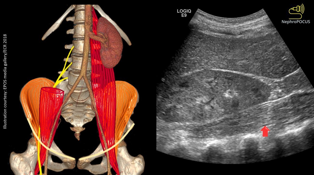 Psoas Muscle And Kidney