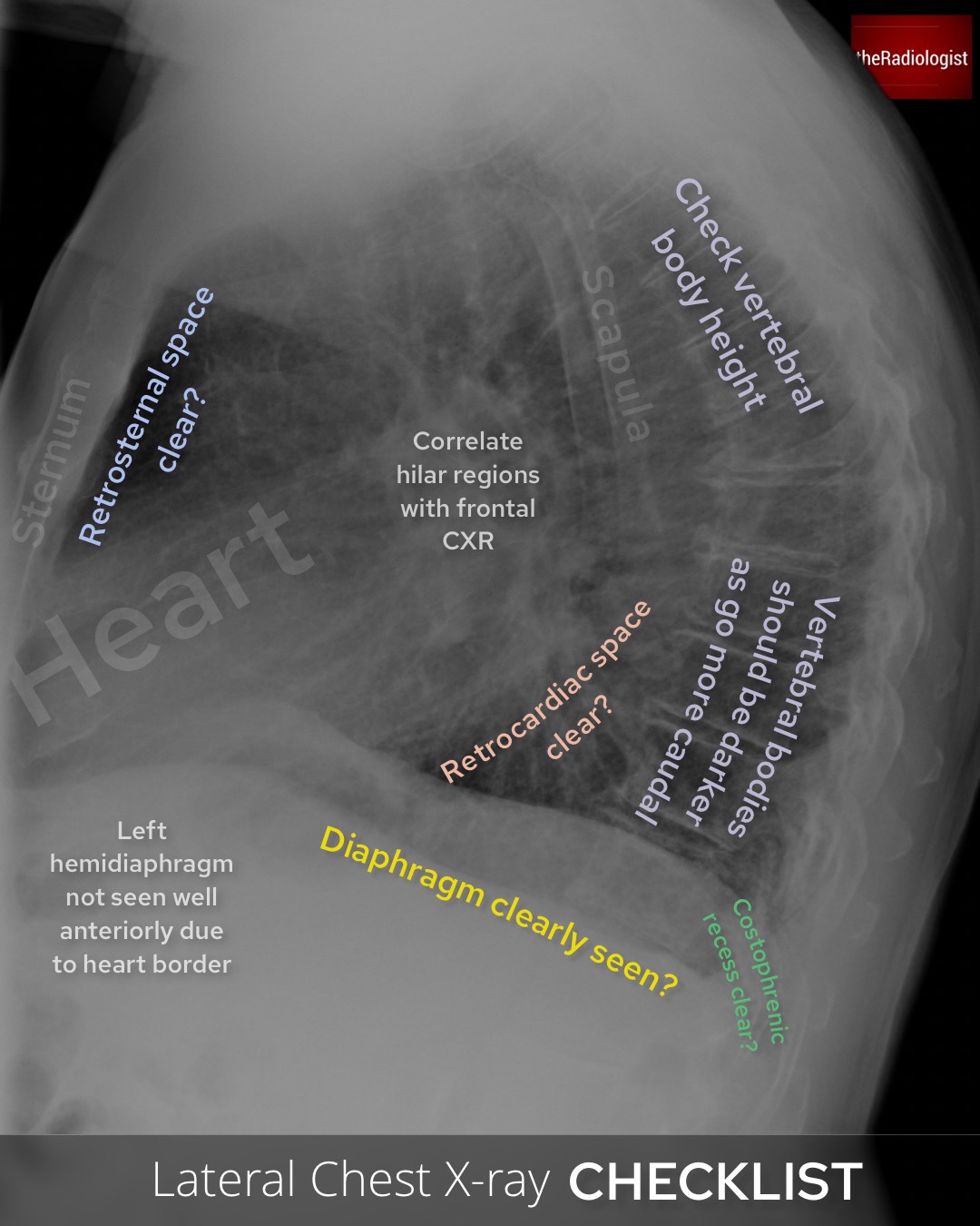 Lateral Chest Xrays