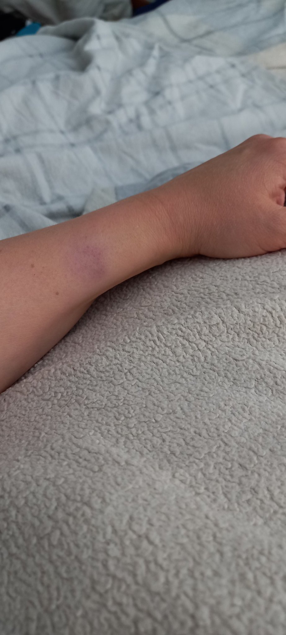 Bruise On Wrist