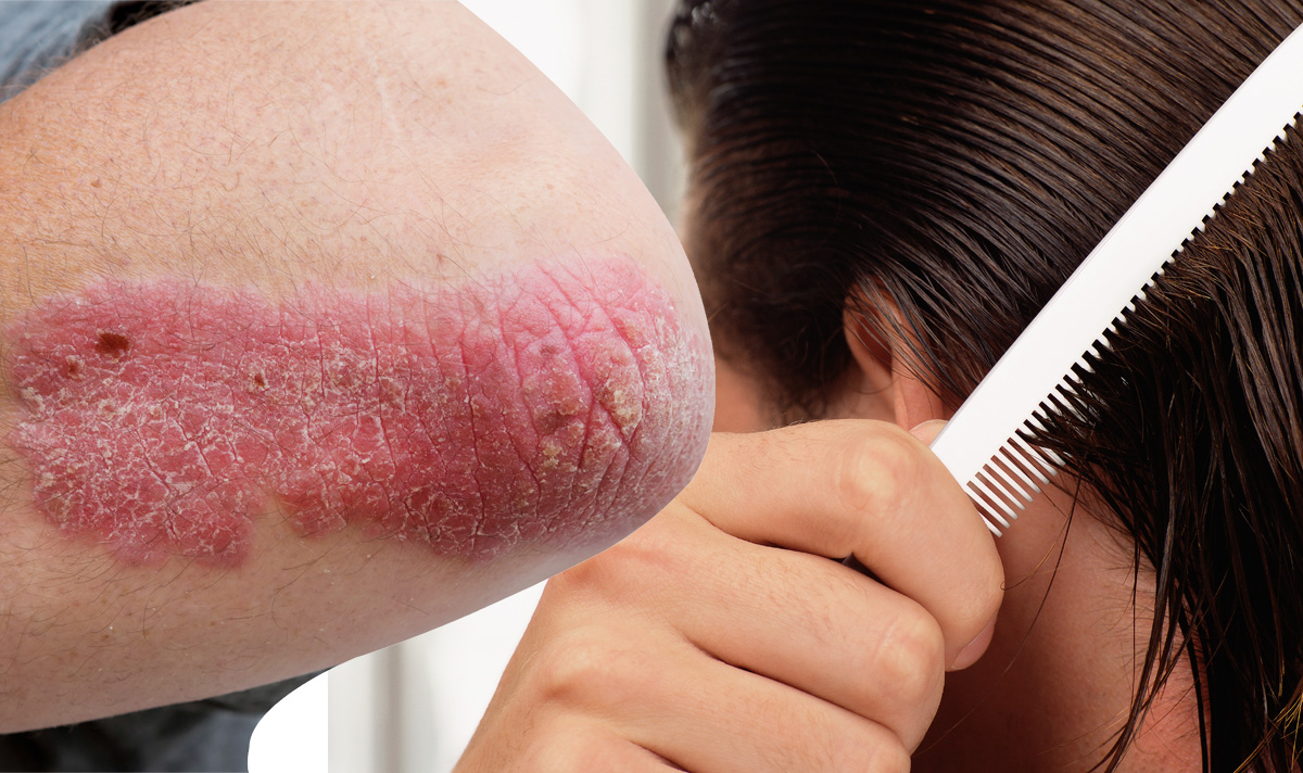 Hair loss warning: Two ‘common’ rashes that can pave the way to ...