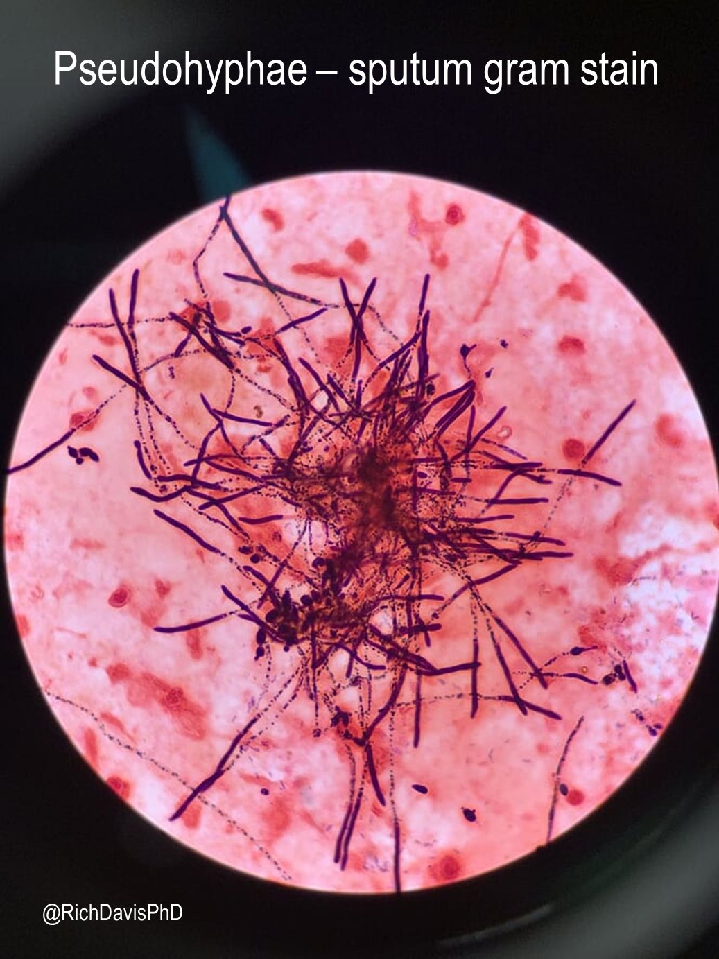 Sputum Culture Gram Stain
