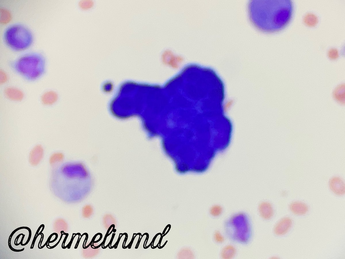 New Criteria for Transfusion-Associated Circulatory Overload (TACO)