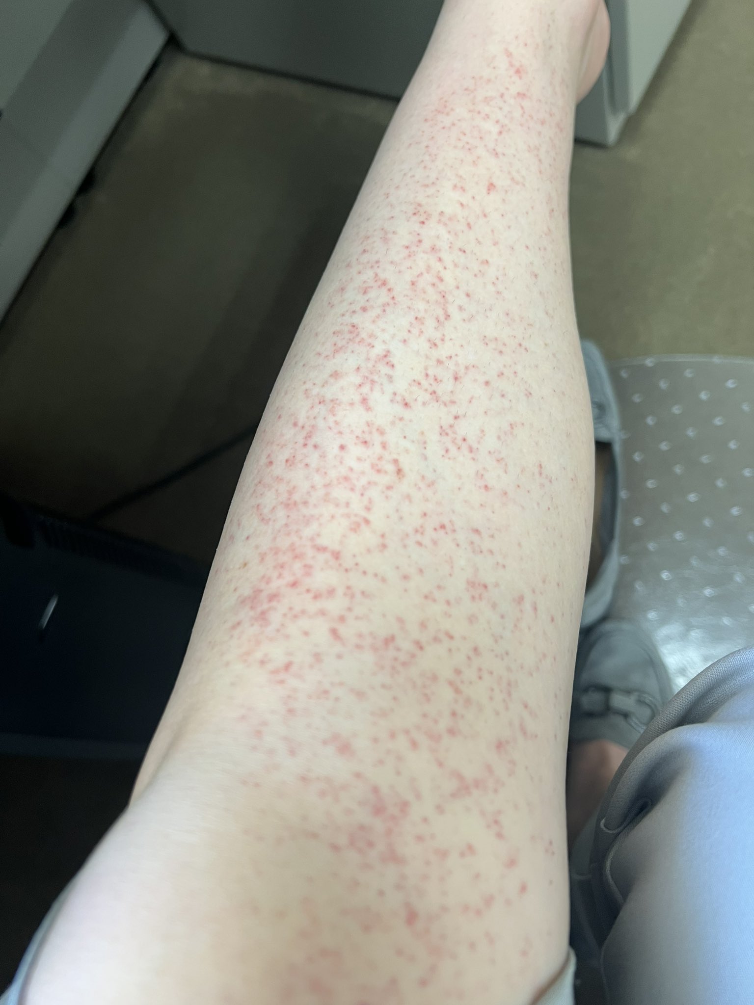 Atopic Dermatitis Legs