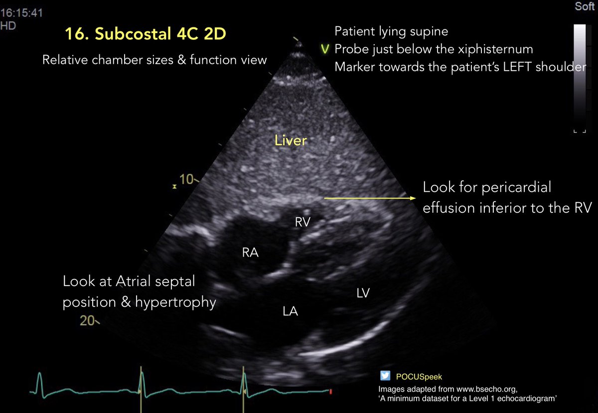 18/18 🧵Minimum DataSet for @BSEcho Level 1 for #firstecho. Images from ...