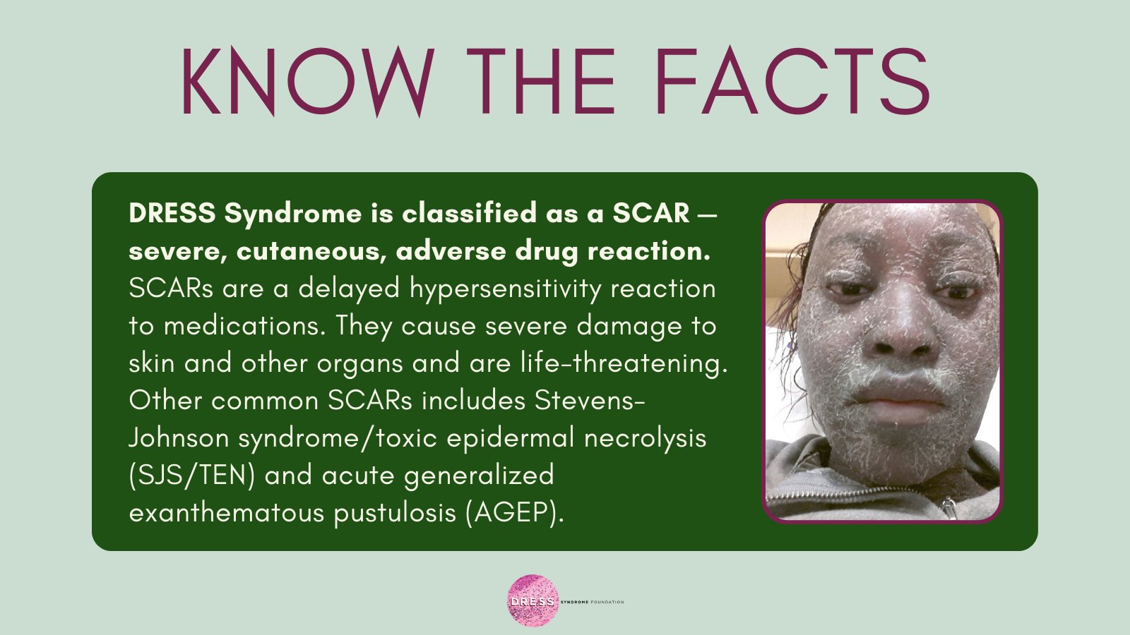 dress stevens johnson syndrome | Dresses Images 2025 dress stevens johnson syndrome | Dresses Images 2025