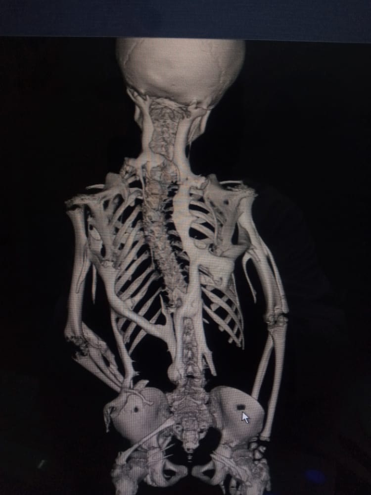 Fibrodysplasia Ossificans Progressiva Skeleton