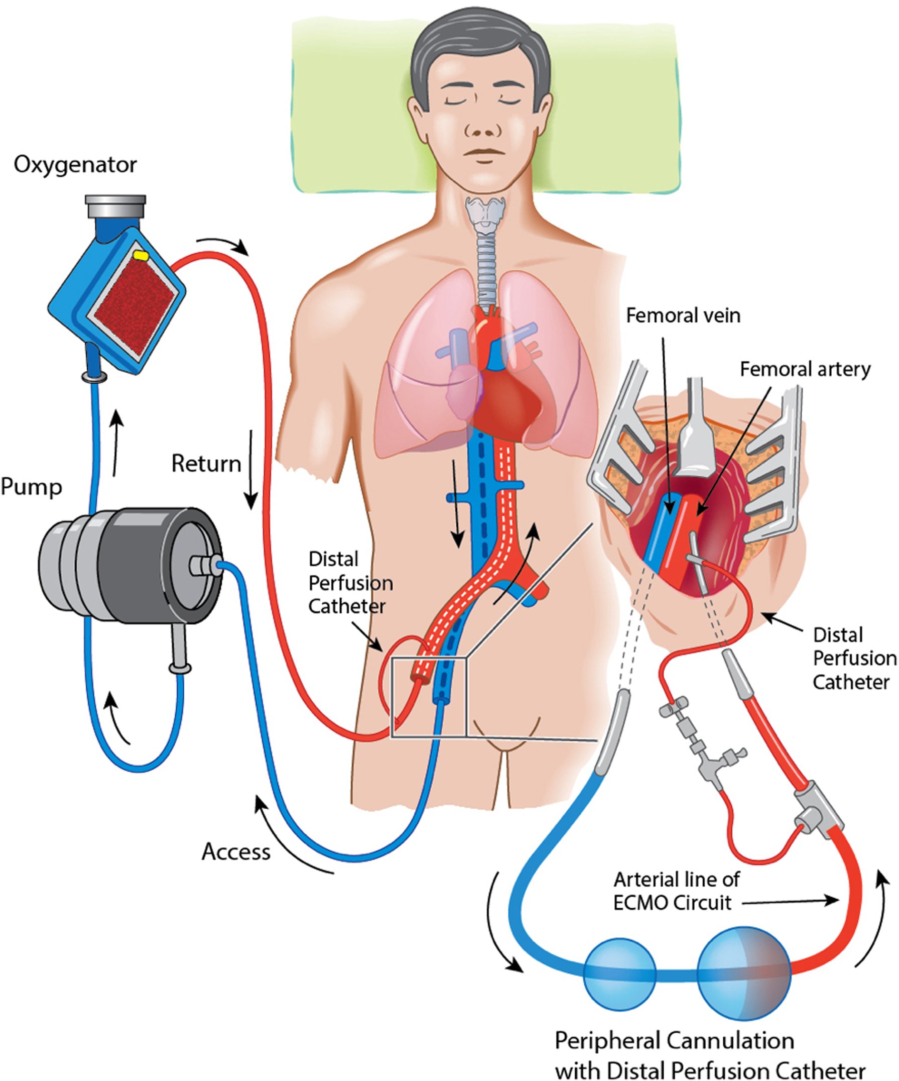 Vv Ecmo Circuit