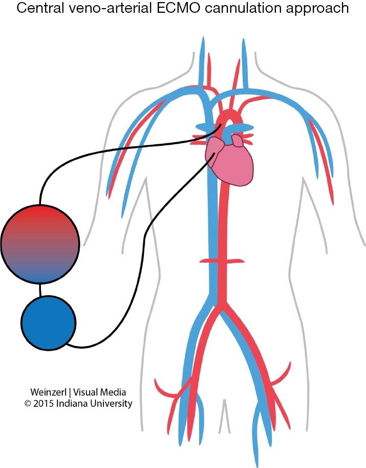 Vv Ecmo Cannula Placement