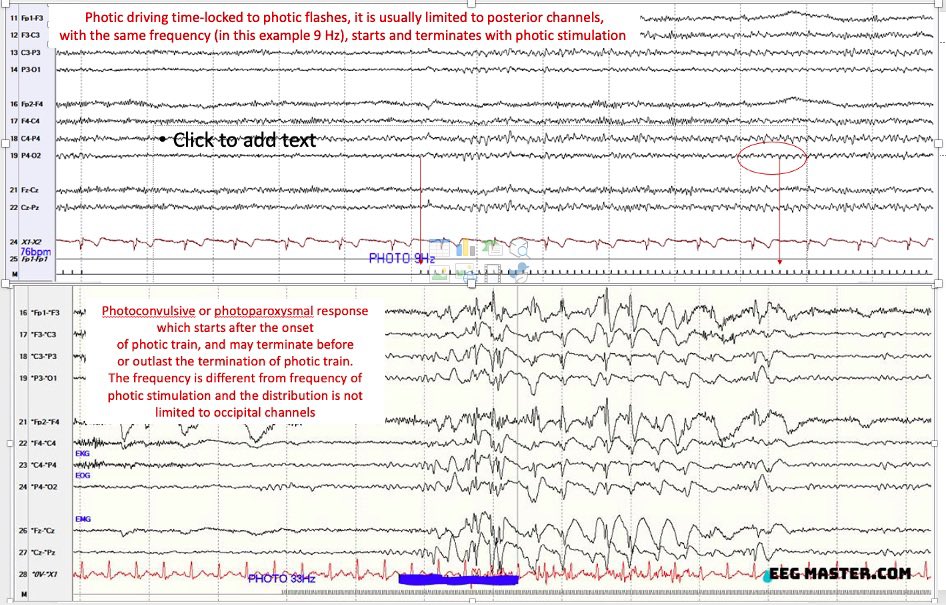 Intermittent Photic Stimulation An Overview ScienceDirect, 57% OFF