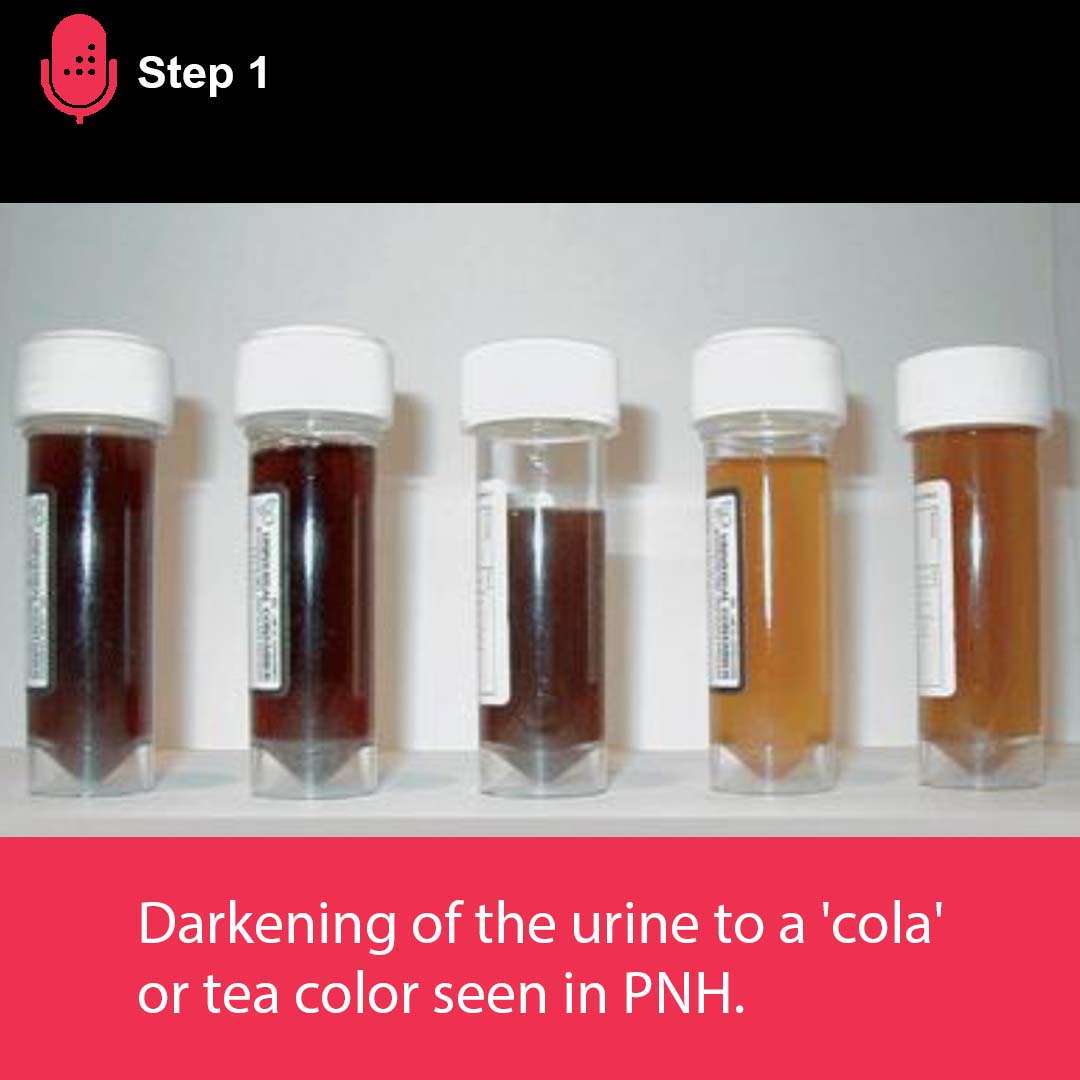 Concentrated Urine Color