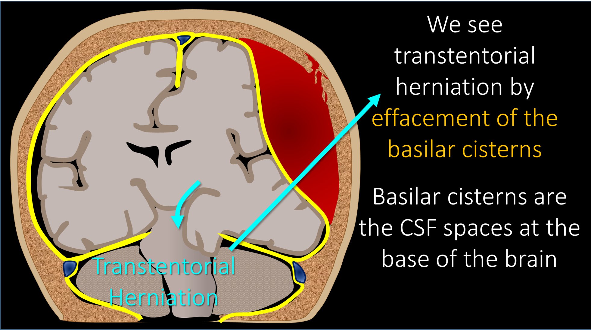 Tentorial Herniation