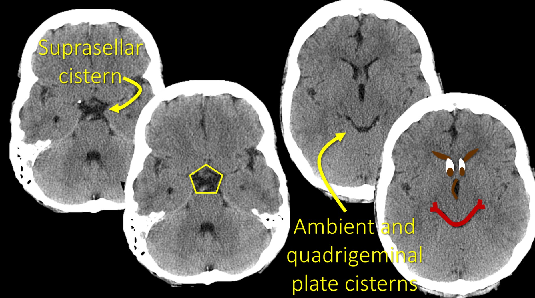 Quadrigeminal Cistern Mri Intracranial Epidermoid Cyst Wikipedia