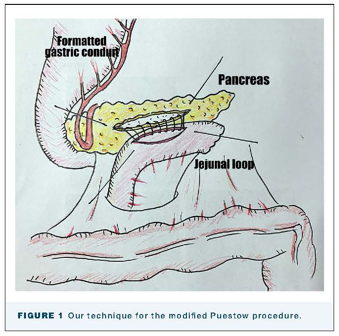 Puestow Procedure