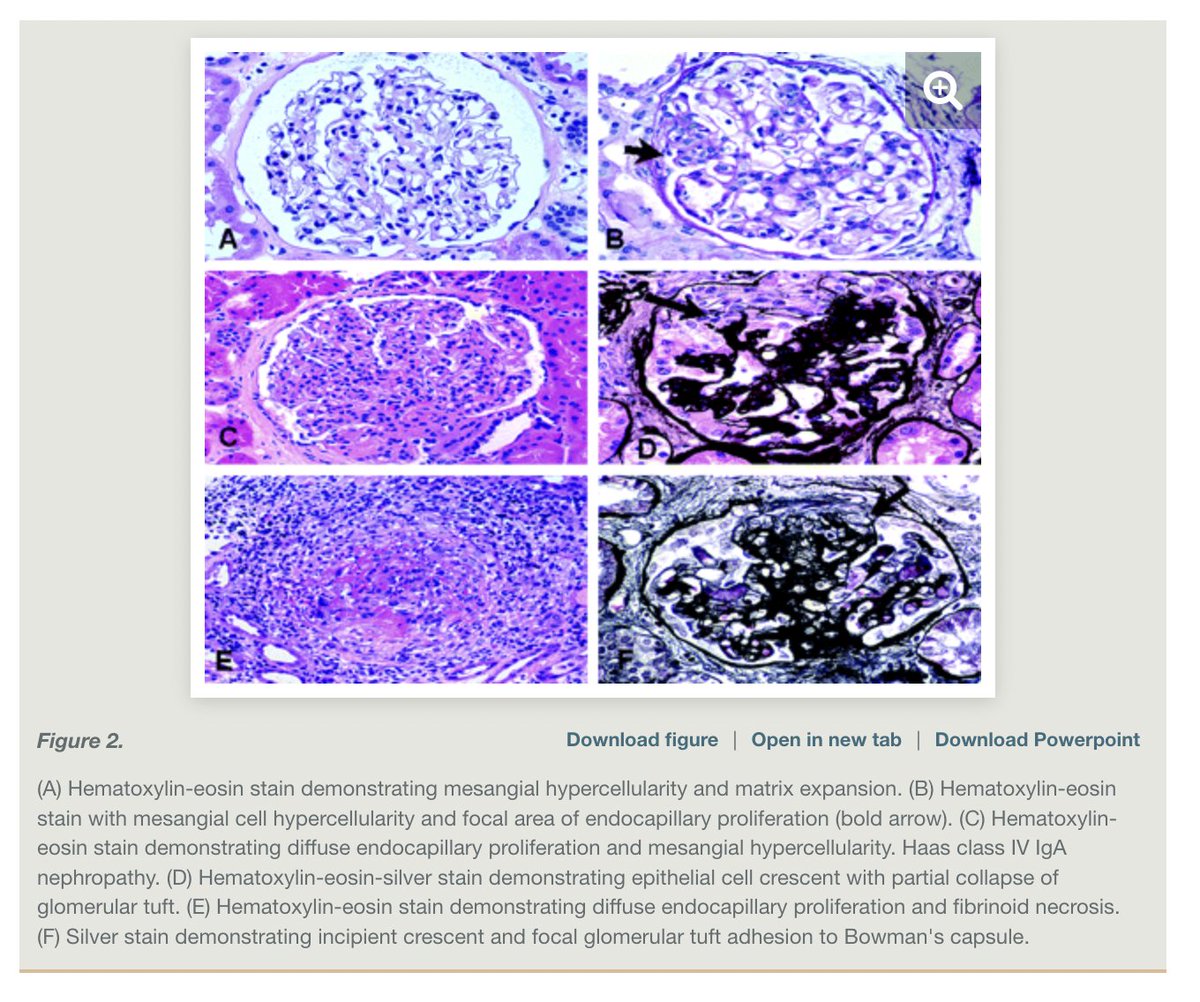 Diagnostic reasoning based on Rx-response & Histopathology An unexpected response to Rx may ...