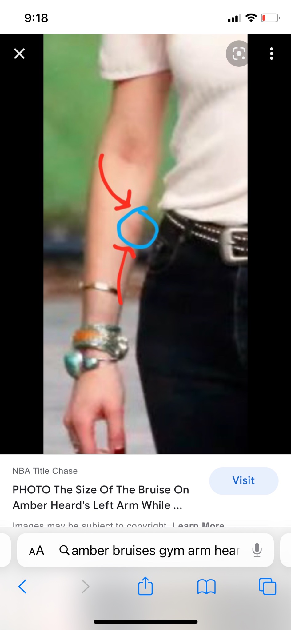 Handprint Bruise On Arm