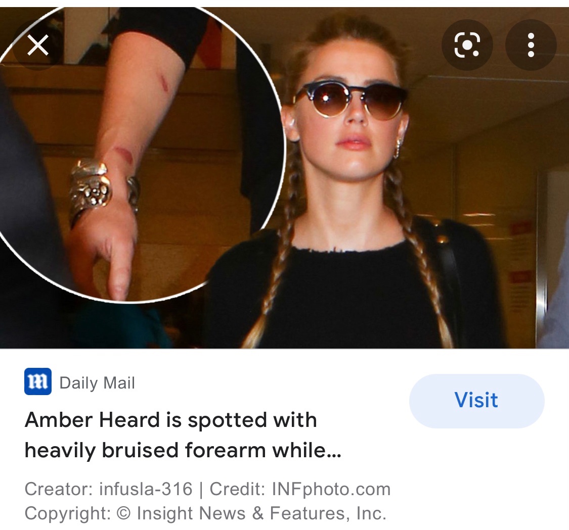 Handprint Bruise On Arm