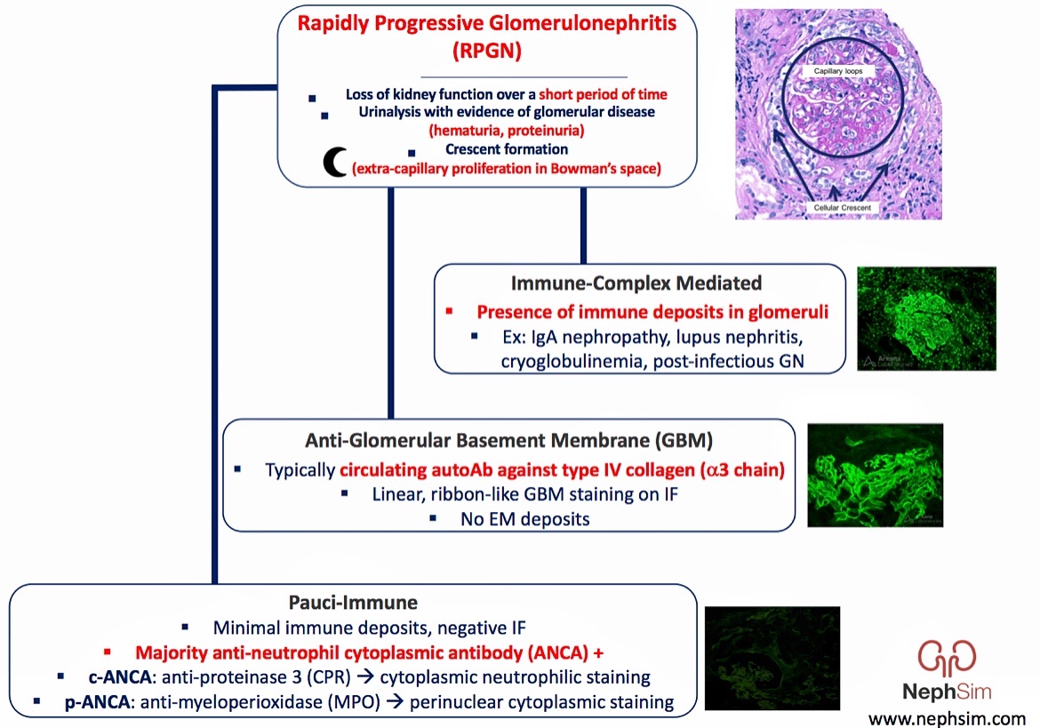 Rapidly Progressive Glomerulonephritis Em