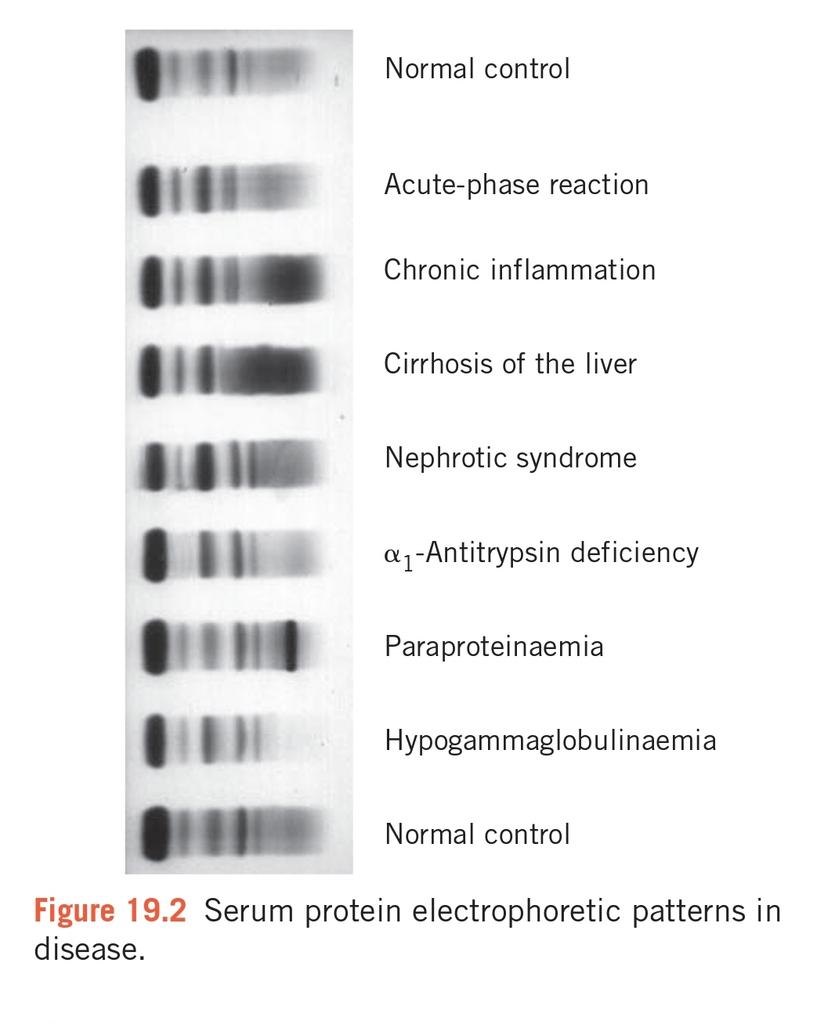 Serum protein electrophoresis test (SPET).. نزلت امس صورة فالبعض طلب ...
