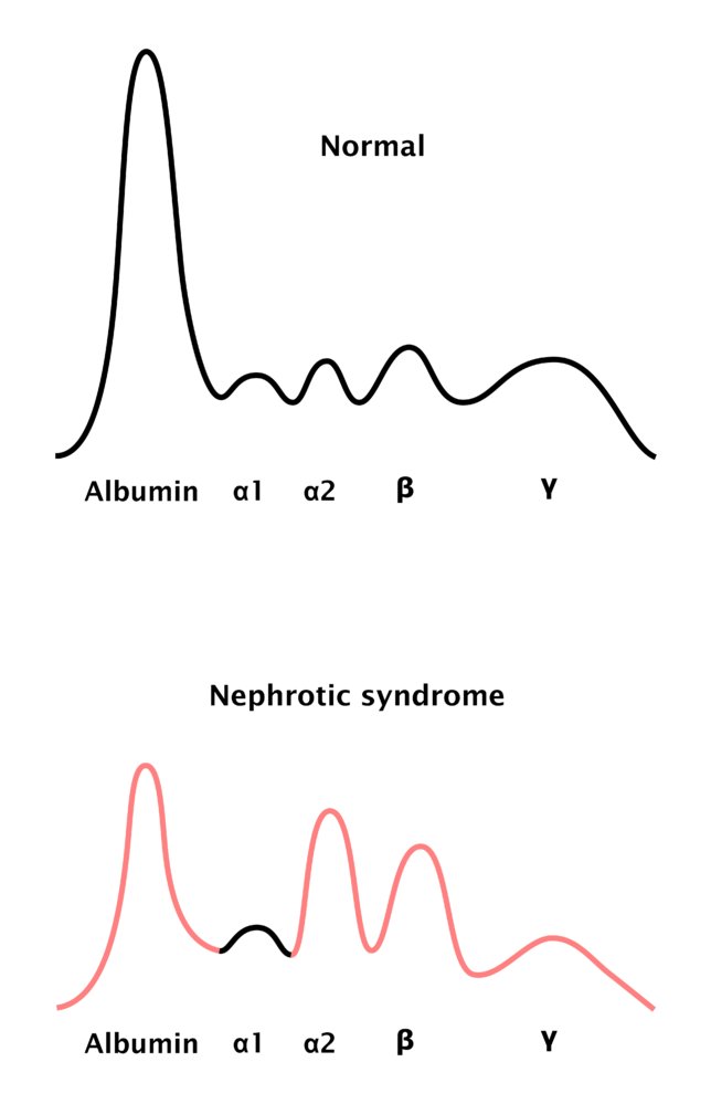 Serum protein electrophoresis test (SPET).. نزلت امس صورة فالبعض طلب ...