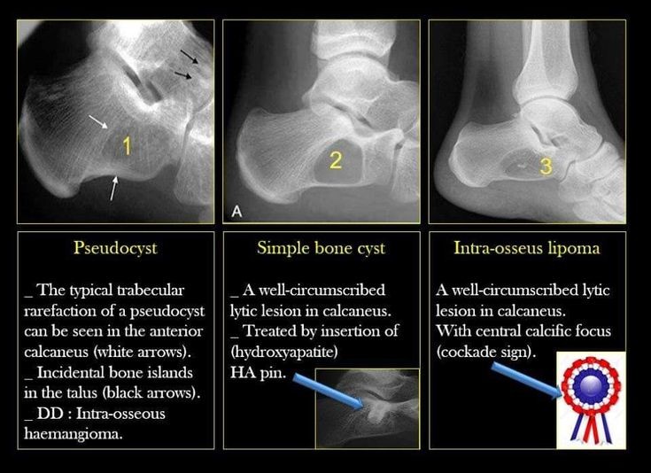 Unicameral Bone Cyst Calcaneus Surgery