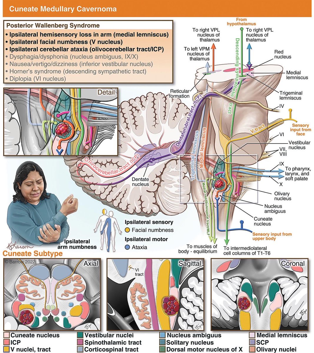 Wallenberg Syndrome Clinico Radiological Profile Of Patients With