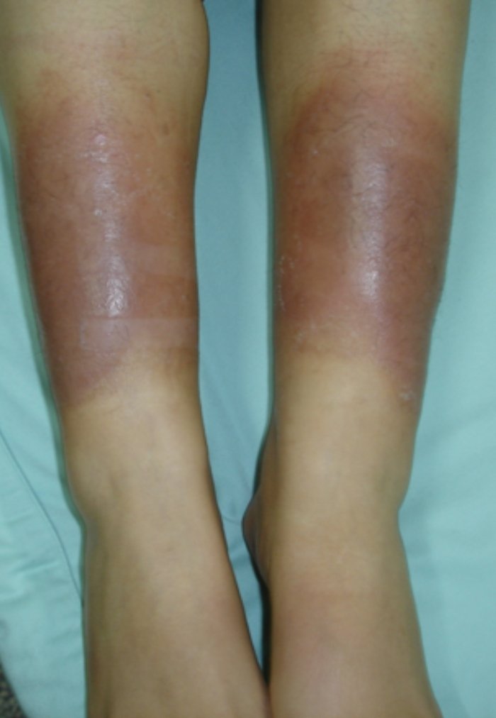 Pretibial Myxedema