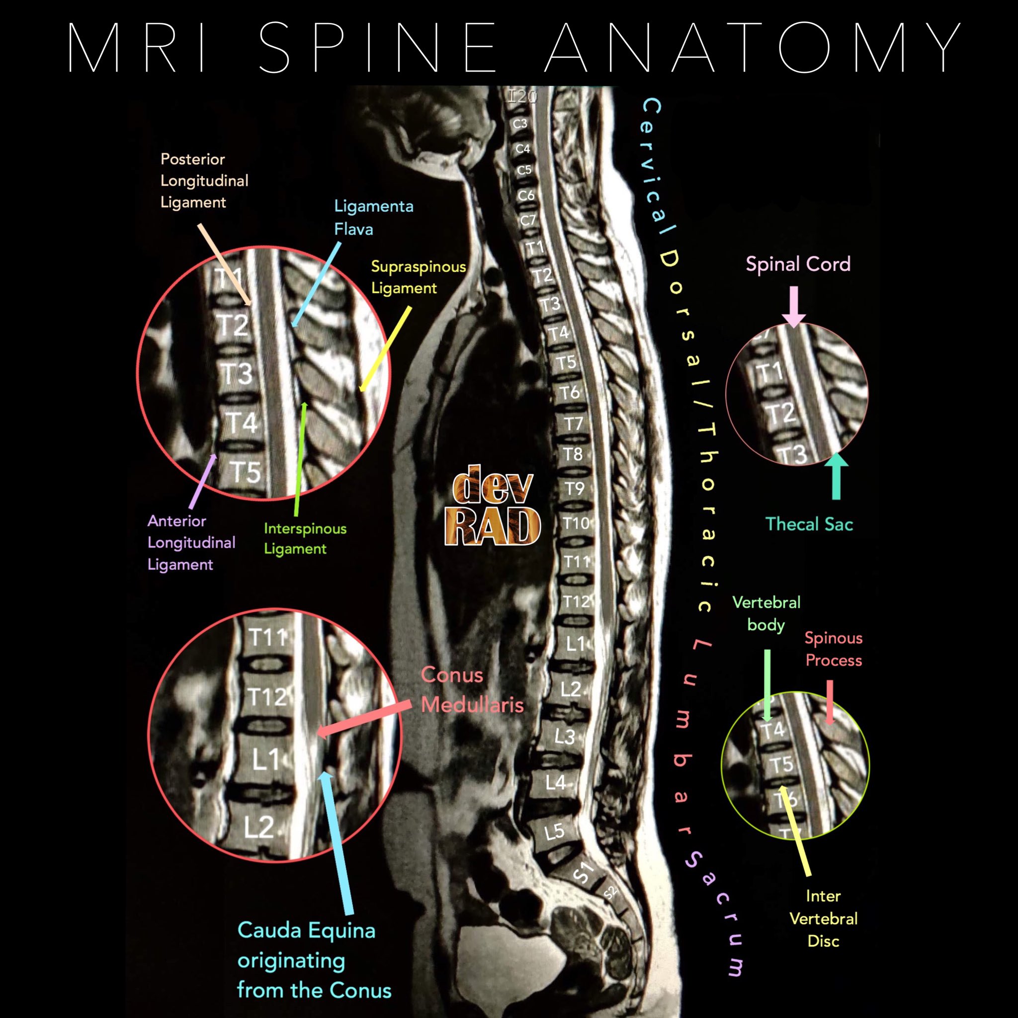 Cervical Spine Mri Labeled