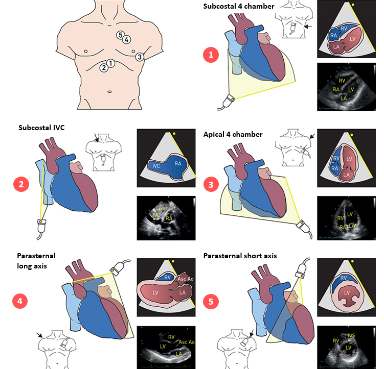 NephroPOCUS on Twitter: "Basic cardiac views #echofirst #POCUS #MedEd From: 🔗https://t.co ...