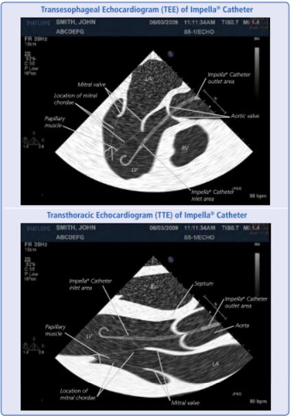 What's going on with the Impella? As a follow up to my previous # ...