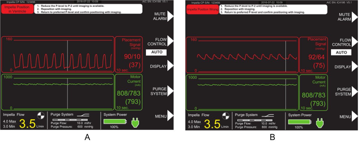 What's going on with the Impella? As a follow up to my previous # ...