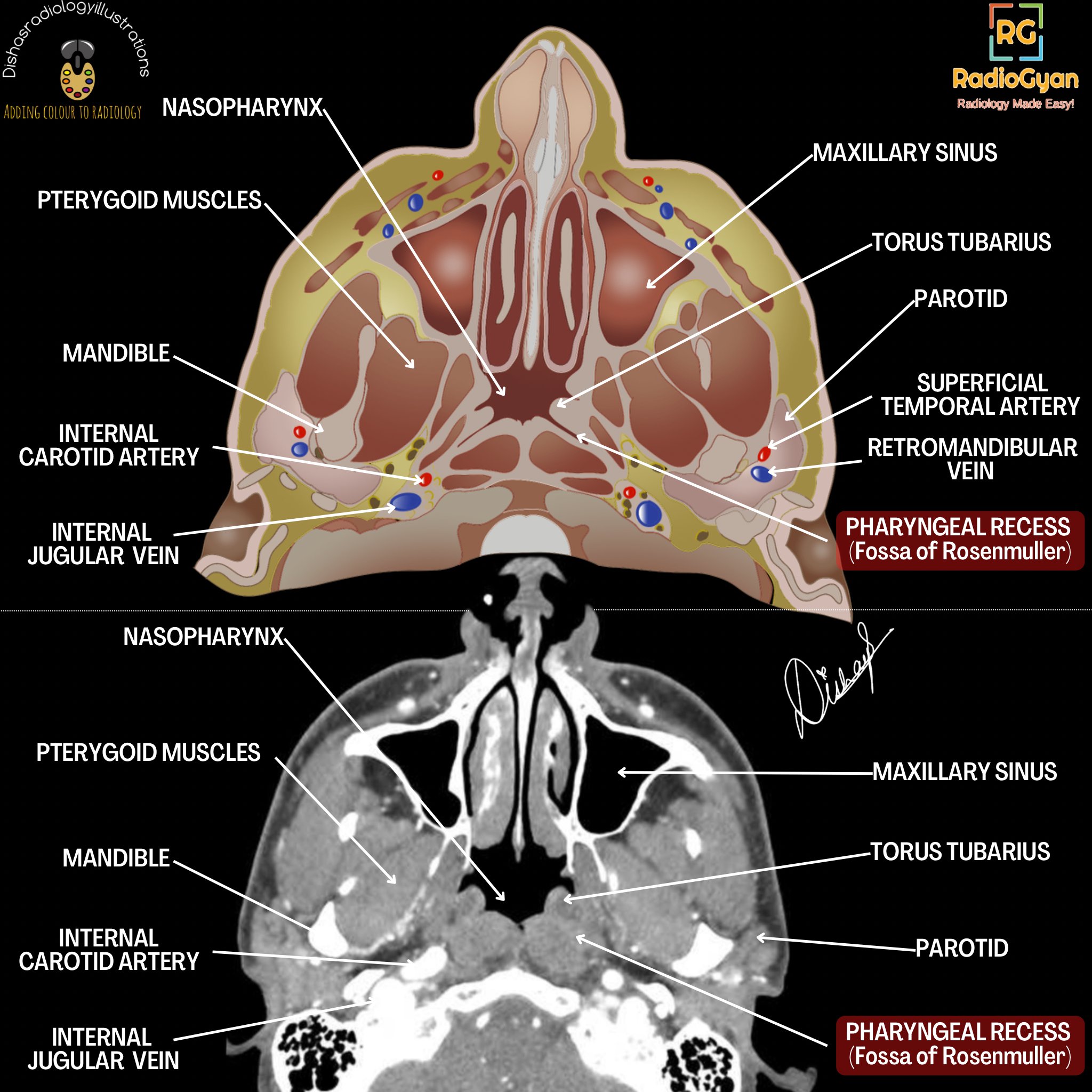 Nasopharynx Anatomy Axial