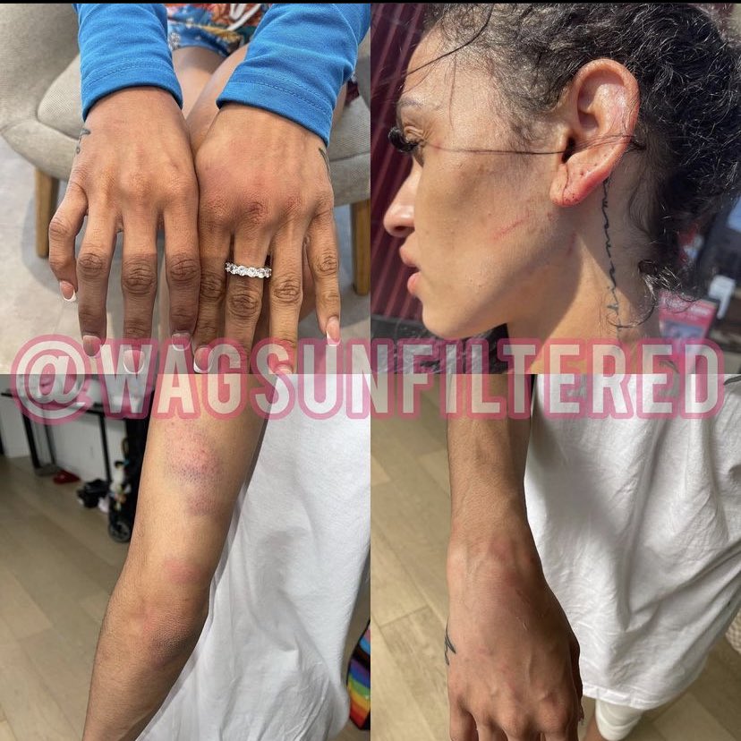 Pharrell Tattoo Removal 2022