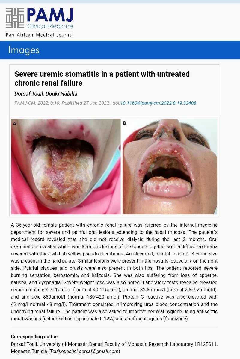 Uremic Stomatitis