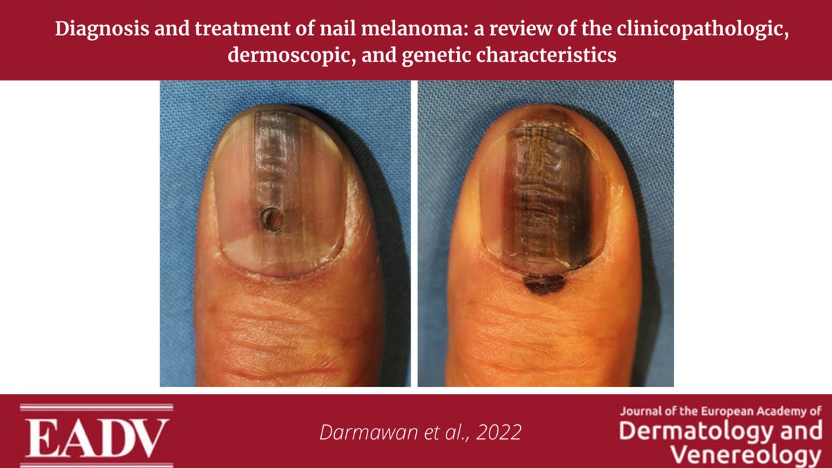 Longitudinal Melanonychia Pictures Pigmented Nail Disorders