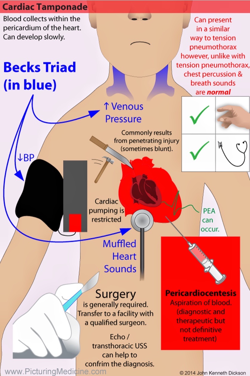 Cardiac Tamponade Diagram