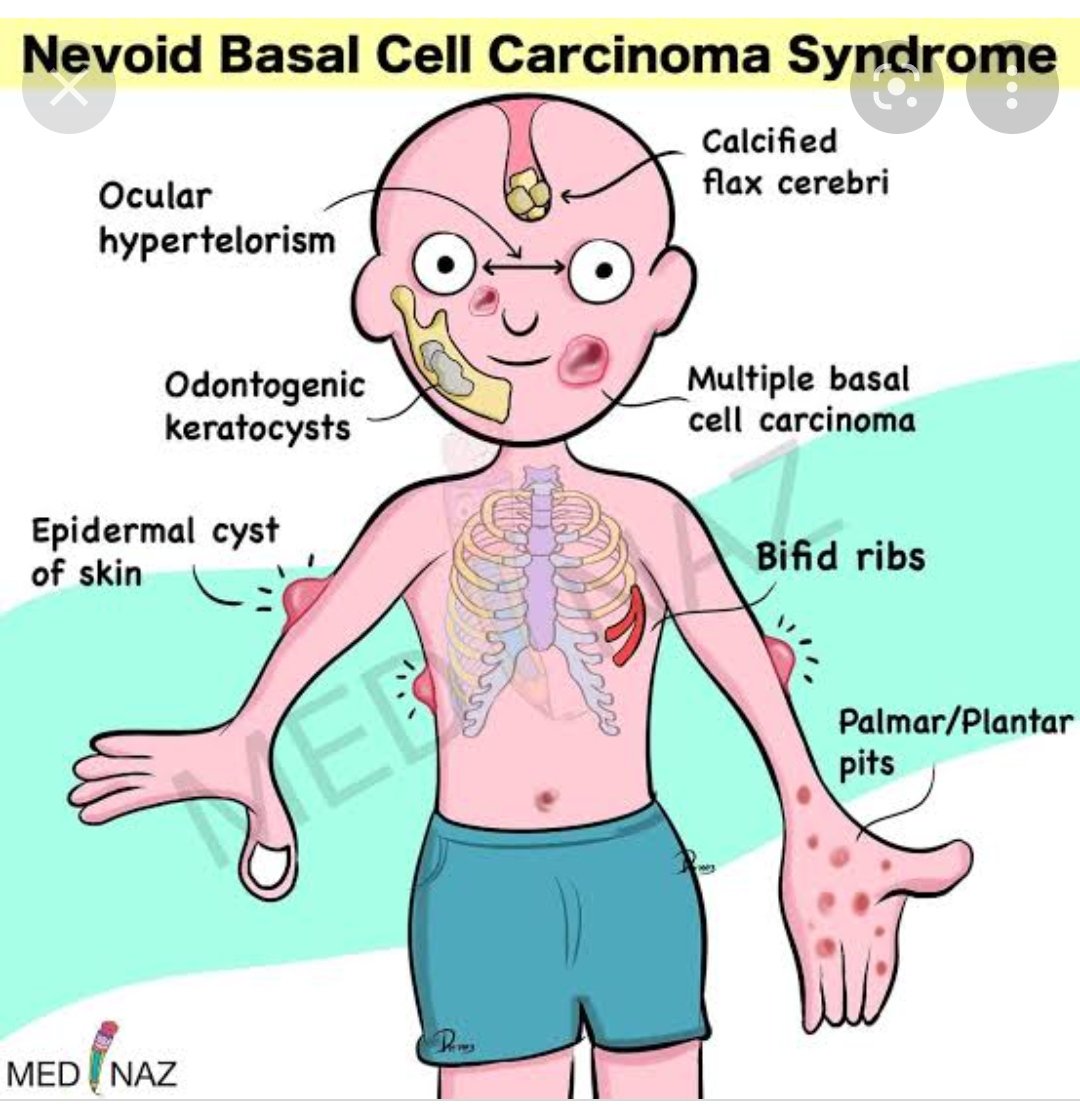 Gorlin Syndrome