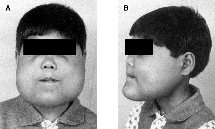 Cherubism Before And After