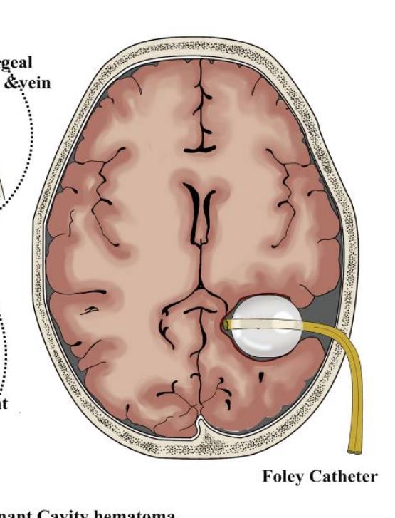 The non-urologic uses of Foley catheters - head and neck edition. A ...