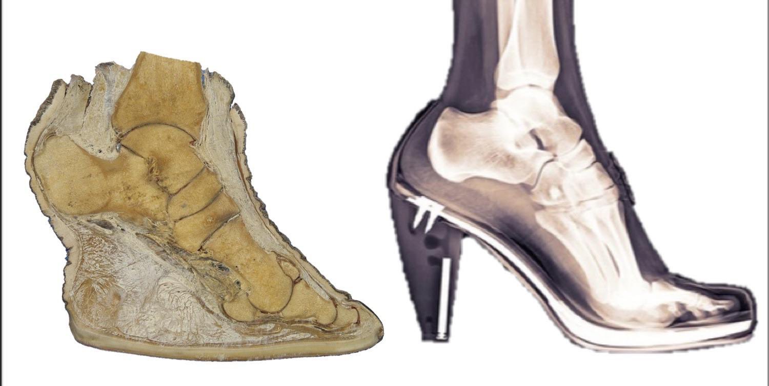 X Ray Of Elephant Foot Unrecognized Glenoid Fracture In Opposite