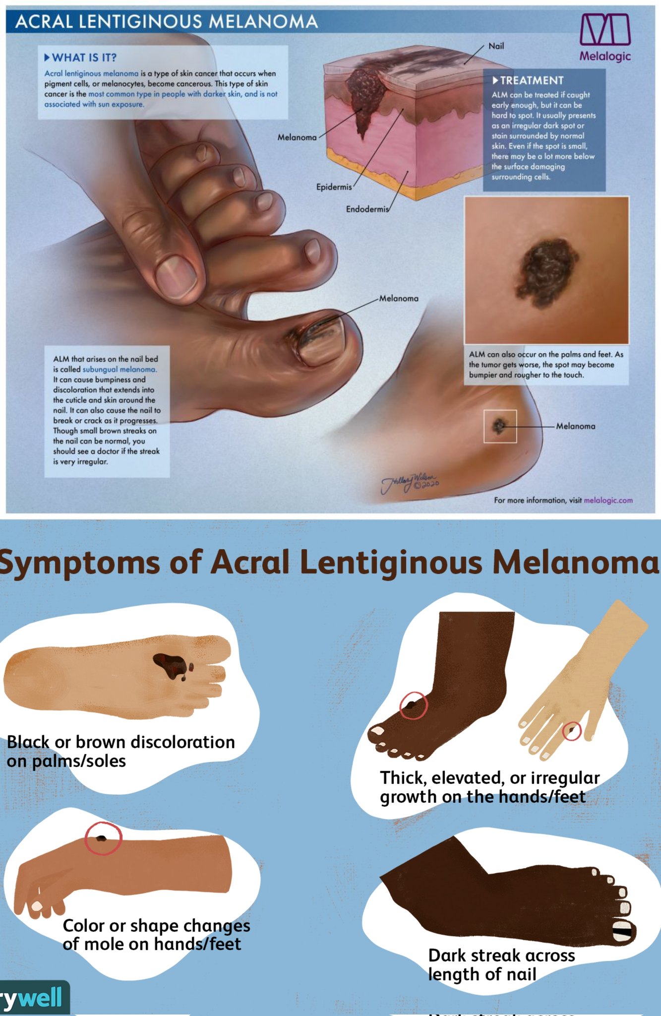 Acral Lentiginous Melanoma